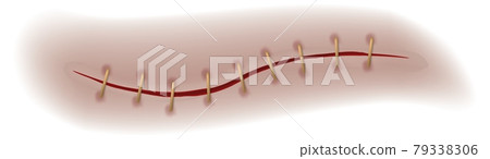 Scar or wound. Realistic bloody stitch....-插圖素材 [79338306] - PIXTA圖庫