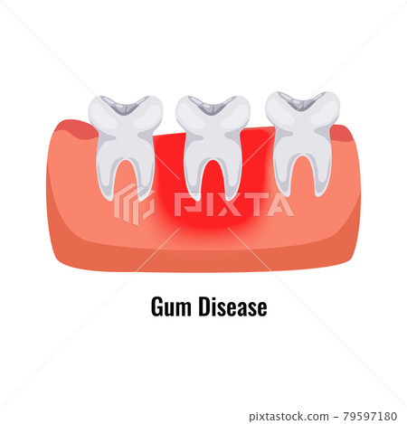 Dental Problem Poster - Stock Illustration [79597180] - PIXTA