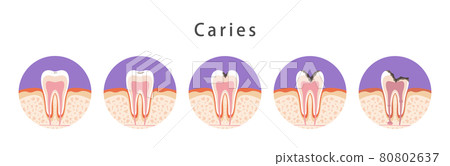Illustration of dentist Dental caries picture set - Stock Illustration ...