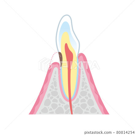 Root caries illustration illustration - Stock Illustration [80814254 ...