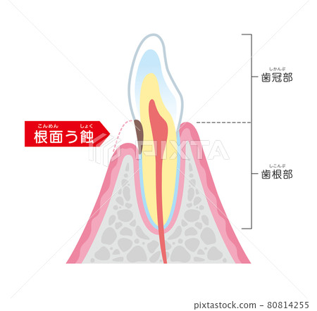Root caries illustration illustration - Stock Illustration [80814255 ...
