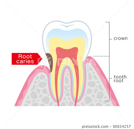 Root caries illustration illustration in English - Stock Illustration ...