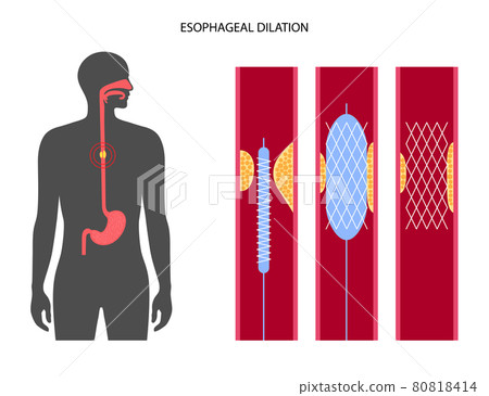Esophageal dilation procedure-插圖素材 [80818414] - PIXTA圖庫