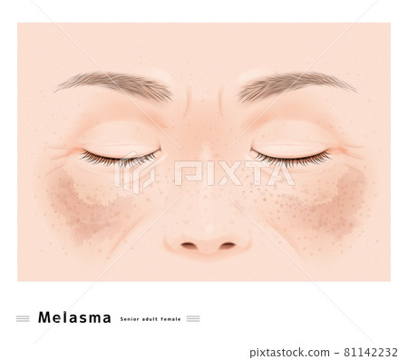 Chloasma Senior Law Line Middle-aged Elderly... - Stock Illustration ...