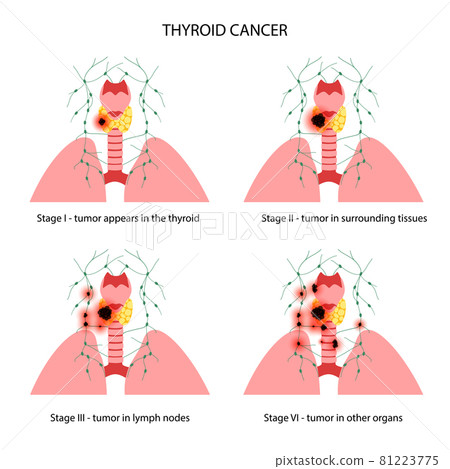 Thyroid cancer stages - Stock Illustration [81223775] - PIXTA