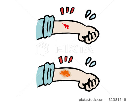 Two types of injured arm illustrations - Stock Illustration [81381346 ...