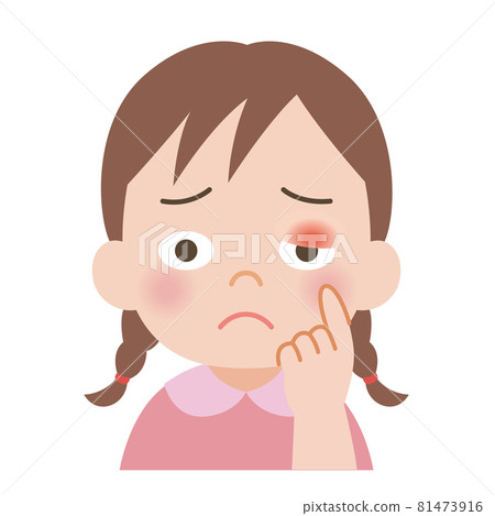 Girl with swollen eyelids - Stock Illustration [81473916] - PIXTA