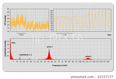 Intracranial Pressure Monitoring ICP waveform,... - Stock Illustration ...