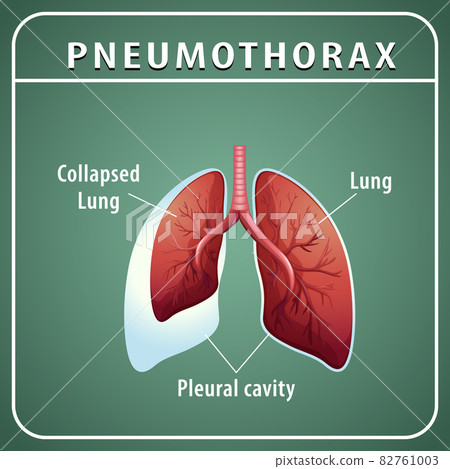 Pneumothorax diagram with collapsed lung and... - Stock Illustration ...