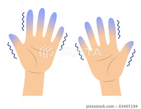 Cold and numbness at your fingertips - Stock Illustration [83405194 ...