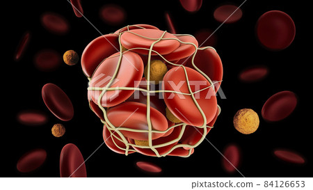 3d Illustration of Deep Vein Thrombosis or... - Stock Illustration ...