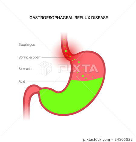 Gastroesophageal reflux disease - Stock Illustration [84505822] - PIXTA