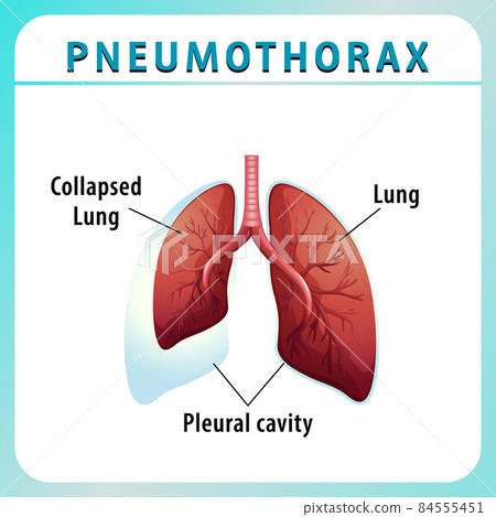 Pneumothorax diagram with collapsed lung and... - Stock Illustration ...