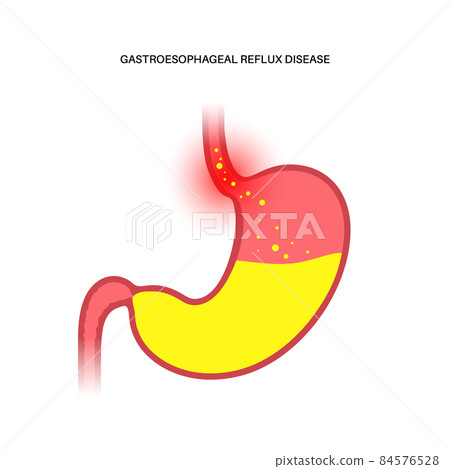 Gastroesophageal reflux disease - Stock Illustration [84576528] - PIXTA