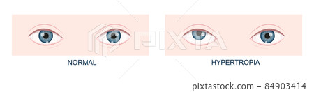 Hypertropia. Vertical strabismus before and...-插圖素材 [84903414] - PIXTA圖庫