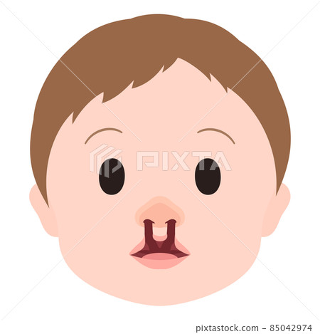 Illustration of bilateral cleft lip and palate... - Stock Illustration ...