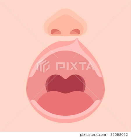 Illustration of cleft lip and palate_cleft... - Stock Illustration ...