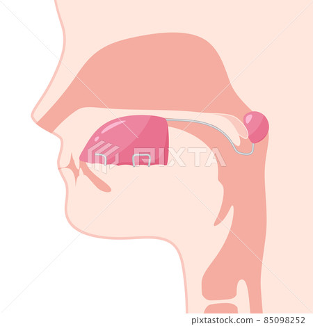 Cleft lip and palate_Illustration of sagittal... - Stock Illustration ...