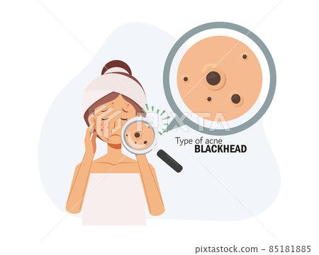 treat acne,skin problem,pimple.woman face.Type... - Stock Illustration ...