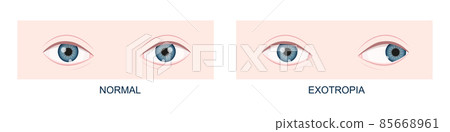 Exotropia. Horizontal strabismus before and... - Stock Illustration ...