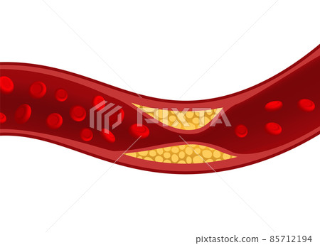Cholesterol artery thrombosis micro vascular... - Stock Illustration ...