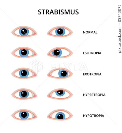 Types of strabismus. Eyes with esotropia,... - Stock Illustration ...