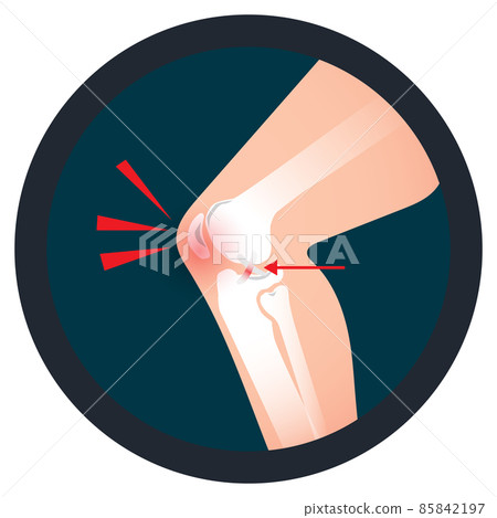 Orthopedics knee icon an injury of ACL or... - Stock Illustration ...