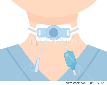 Illustration with a tracheal cannula _ Cannula... - Stock Illustration ...