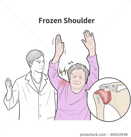 Frozen shoulder disease medical illustration - Stock Illustration ...