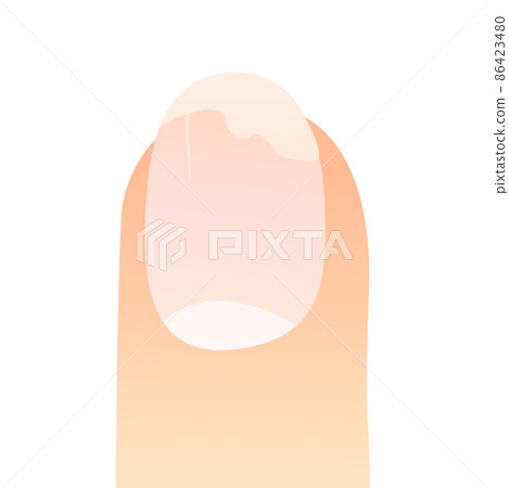 Fingers with onycholysis - Stock Illustration [86423480] - PIXTA