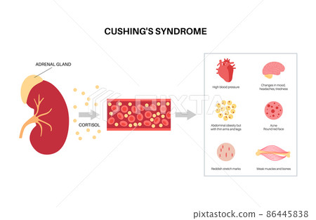 Cushing Desease poster - Stock Illustration [86445838] - PIXTA