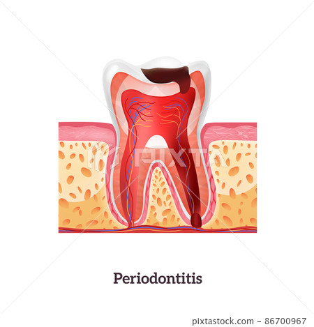 Periodontitis Realistic Illustration - Stock Illustration [86700967 ...
