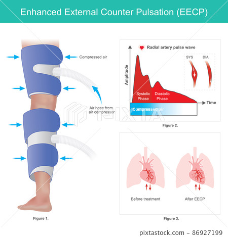 Enhanced External Counter Pulsation. A method... - Stock Illustration ...