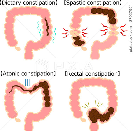 Constipation illustration English - Stock Illustration [87037994] - PIXTA