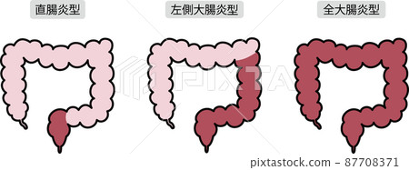 Illustration of ulcerative colitis - Stock Illustration [87708371] - PIXTA