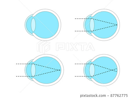 Image of the eyeball in the in-focus state and... - Stock Illustration ...
