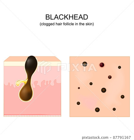 Acne. blackhead. clogged pore. Cross-section of... - Stock Illustration ...