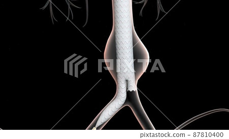 3D medical illustration of pulsatile Abdominal... - Stock Illustration ...