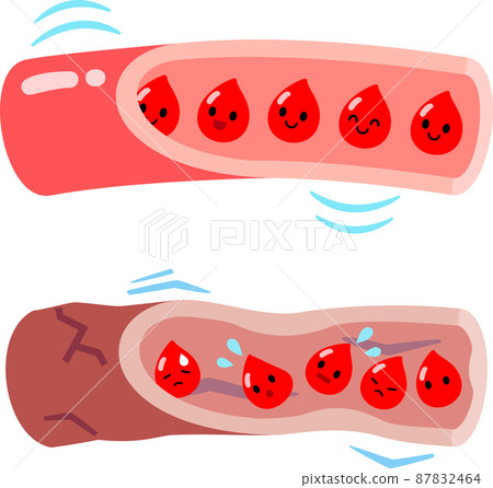 Image of blood flow in soft and hard blood vessels - Stock Illustration ...