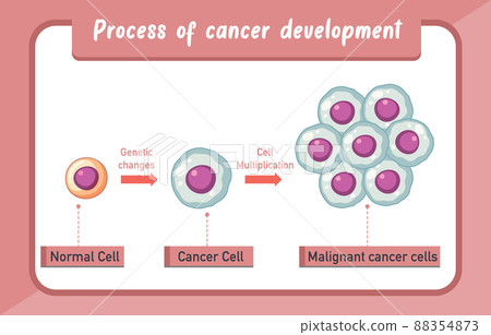Process of cancer development infographic - Stock Illustration ...