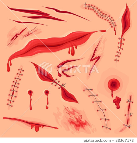 Skin incision wound. Bloody surgery stitch scar... - Stock Illustration [88367178] - PIXTA
