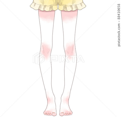 O-legged female legs - Stock Illustration [88410658] - PIXTA