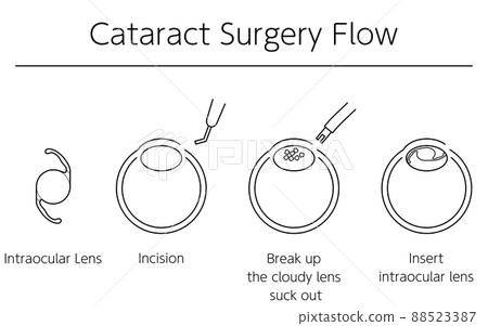 Flow of cataract surgery, illustrated... - Stock Illustration [88523387 ...