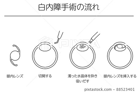 Flow of cataract surgery, illustrated... - Stock Illustration [88523401 ...