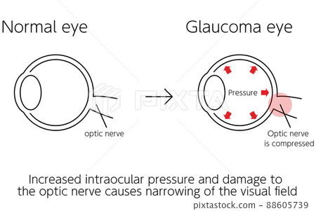 Illustration of how glaucoma works, normal and... - Stock Illustration ...