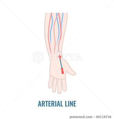 Arterial line catheter placed in the radial artery - Stock Illustration ...