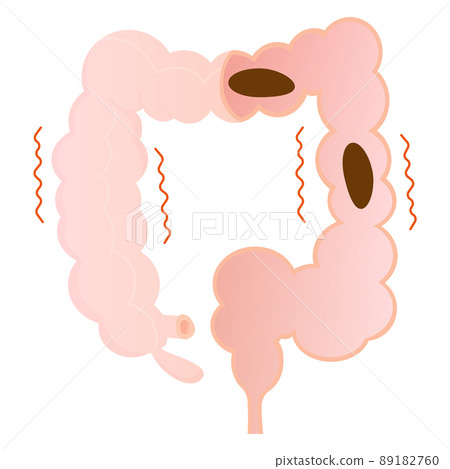 Vector illustration of symptomatic constipation. - Stock Illustration ...