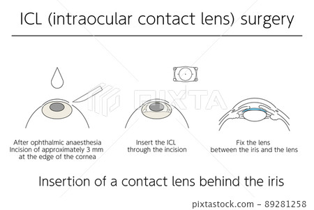 Illustration, vision correction by ICL... - Stock Illustration ...