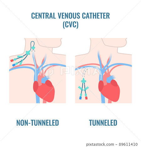 Central line venous catheter types on male body-插圖素材 [89611410] - PIXTA圖庫