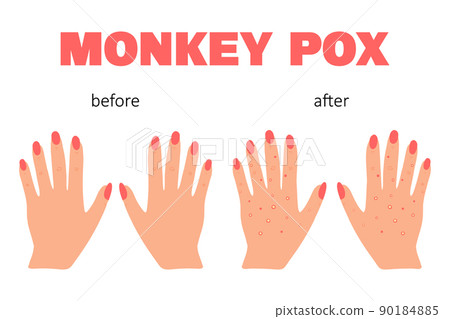 Banner with smallpox monkey. Monkey pox. Hands... - Stock Illustration ...